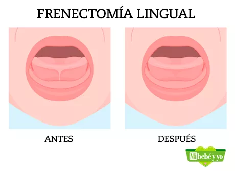 Frenillo lingual corto: qué es y cómo afecta al lenguaje