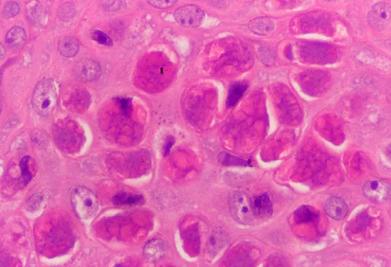 Molusco contagioso en niños: qué es y cómo se elimina